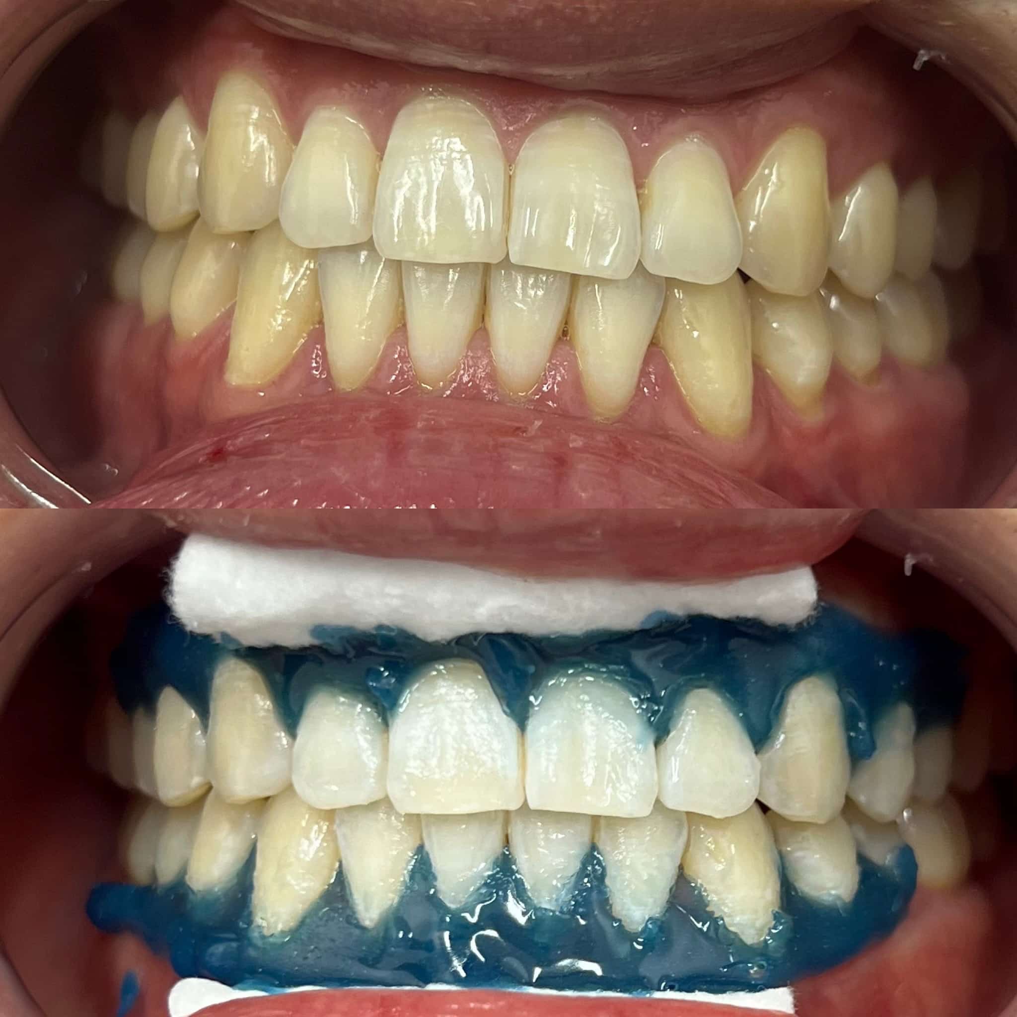 Teeth Whitening | Creekside Premier Dental | Cosmetic Dentist in ...