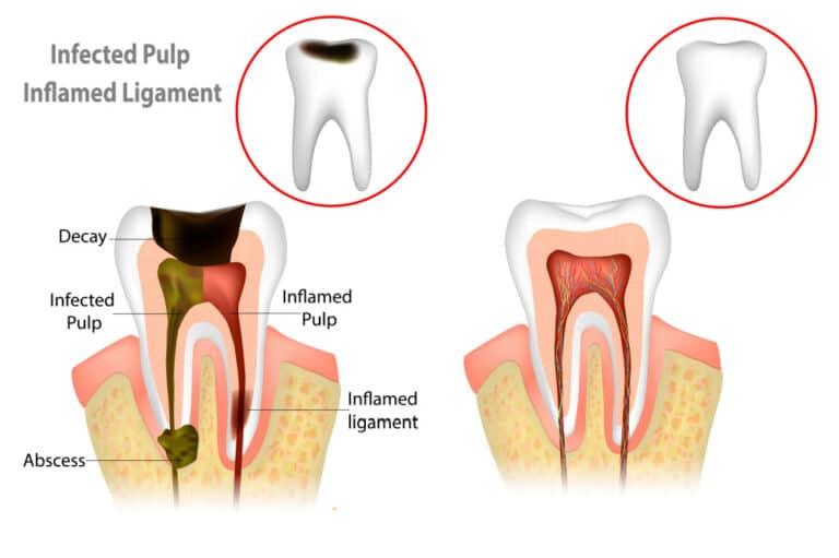 Root Canal Treatment | Creekside Premier Dental | Tooth Restoration & Repair CO 80602