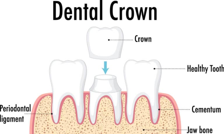 Dental Crowns | Creekside Premier Dental | Teeth Replacement in ...